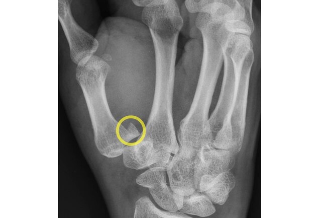 Clay Matthews' Broken Thumb: A Look at His Bennett's Fracture, Rehab ...