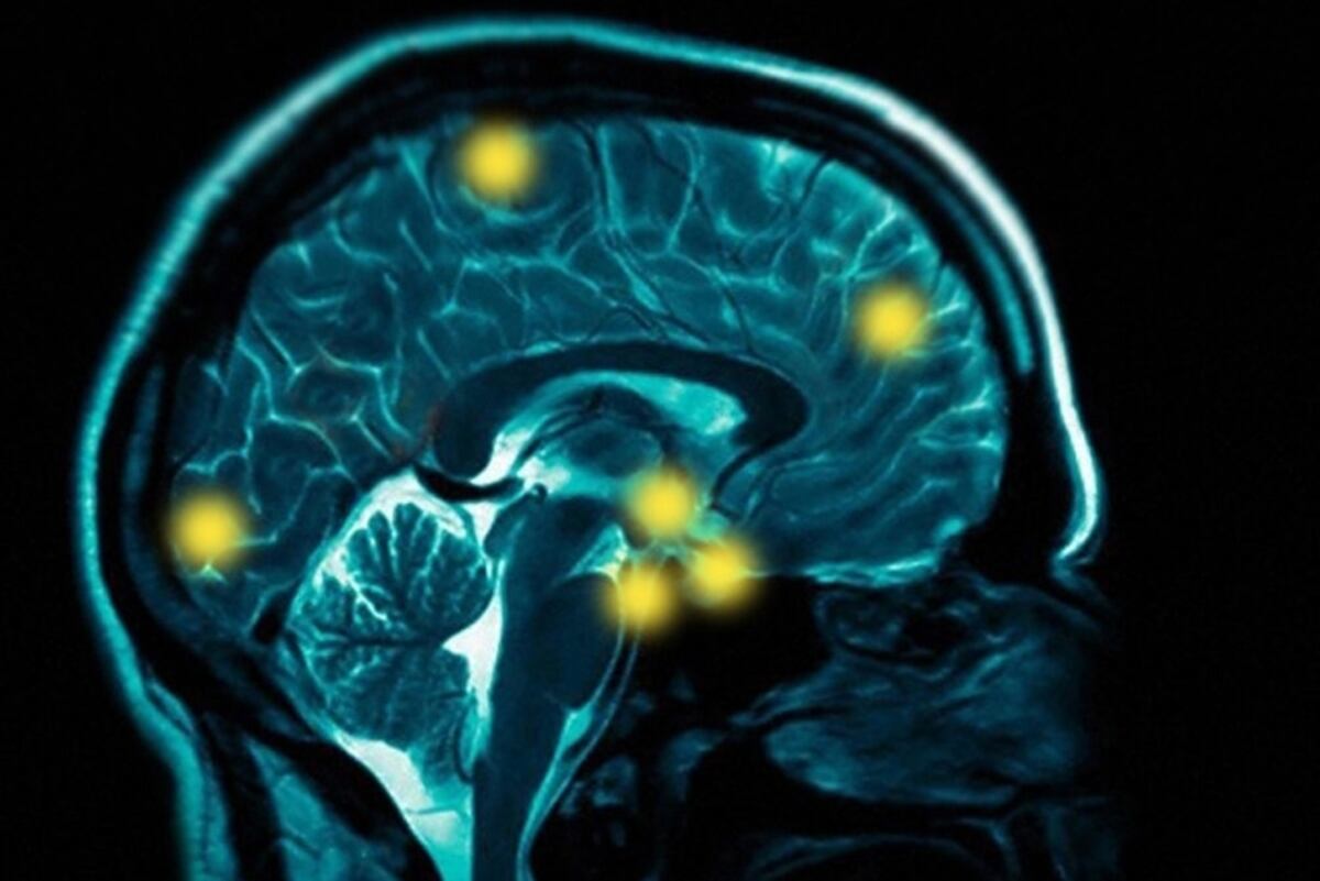 Brain Injury and MMA: A Word to the Wise | News, Scores, Highlights ...