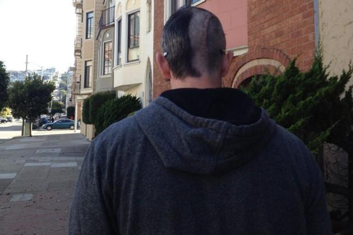 Oakland A's Pitcher Brandon McCarthy Rocking Gnarly Scar After Brain ...